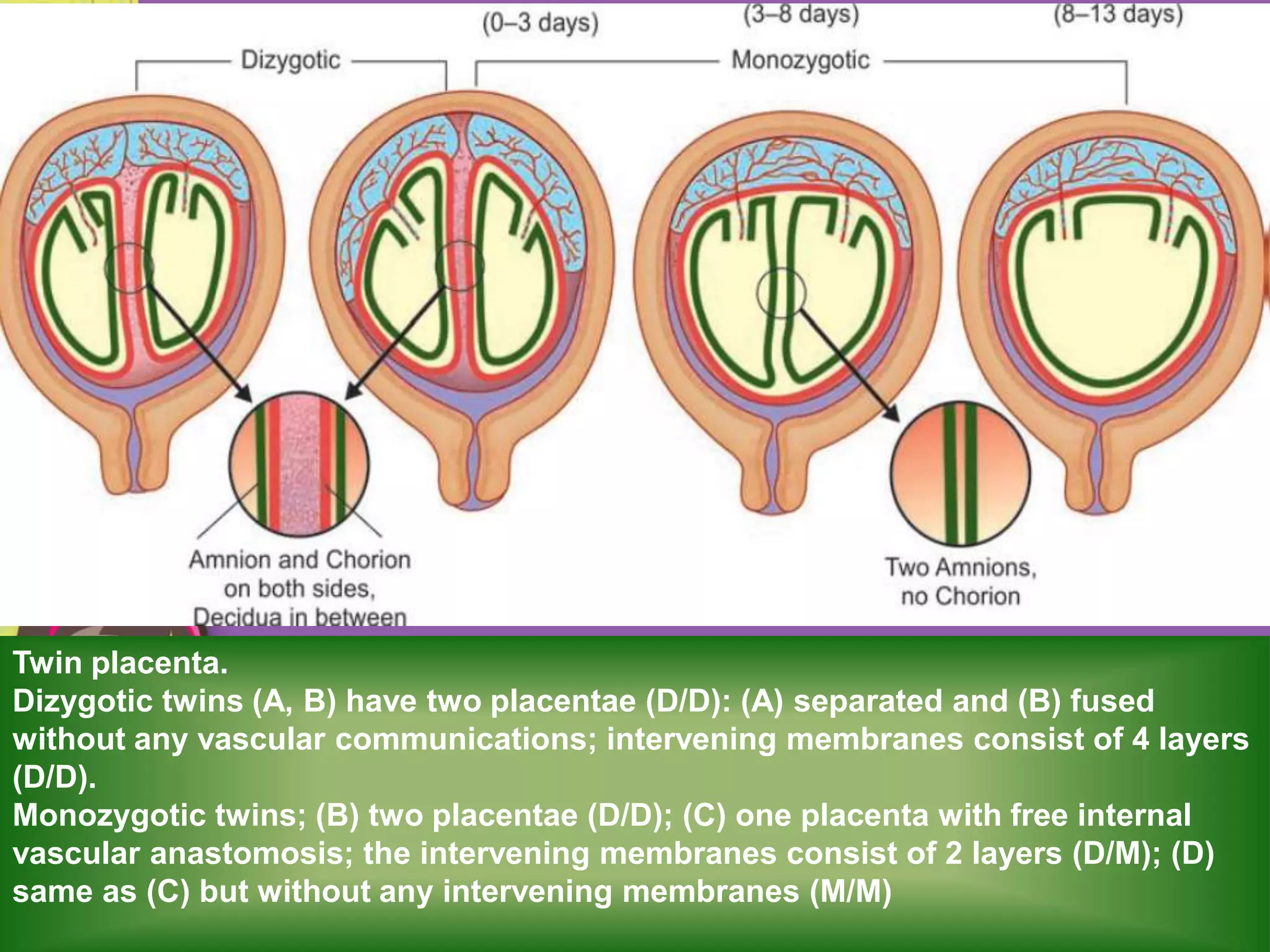 Multiple pregnancy suparna | PPT