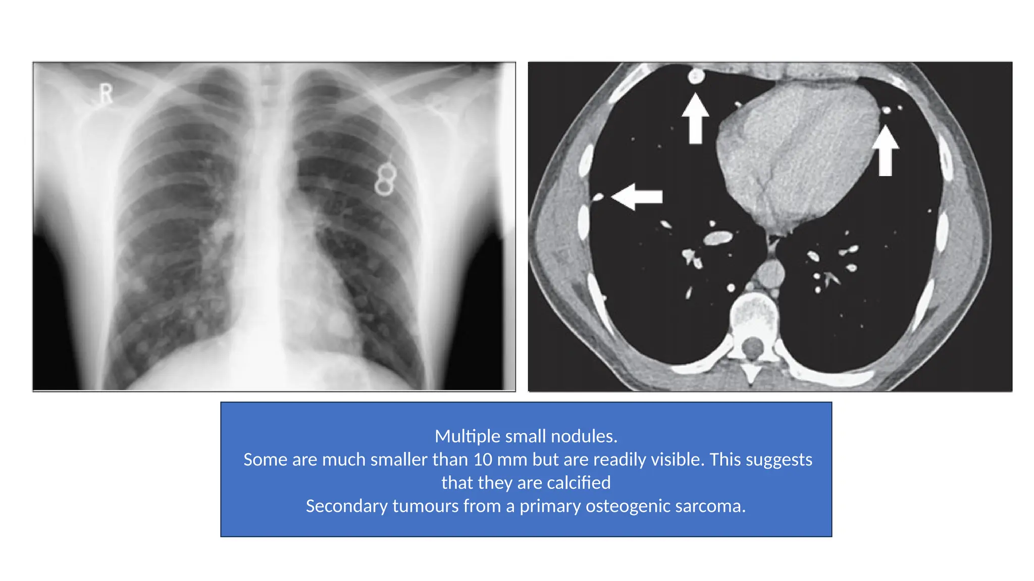 MULTIPLE PULMONARY NODULE xray findings.pptx