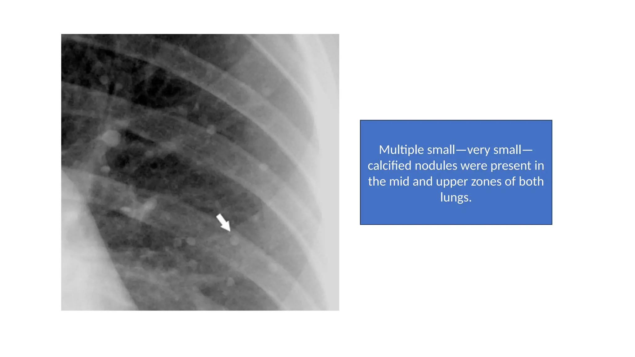 MULTIPLE PULMONARY NODULE xray findings.pptx