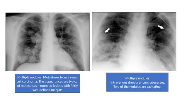 MULTIPLE PULMONARY NODULE xray findings.pptx