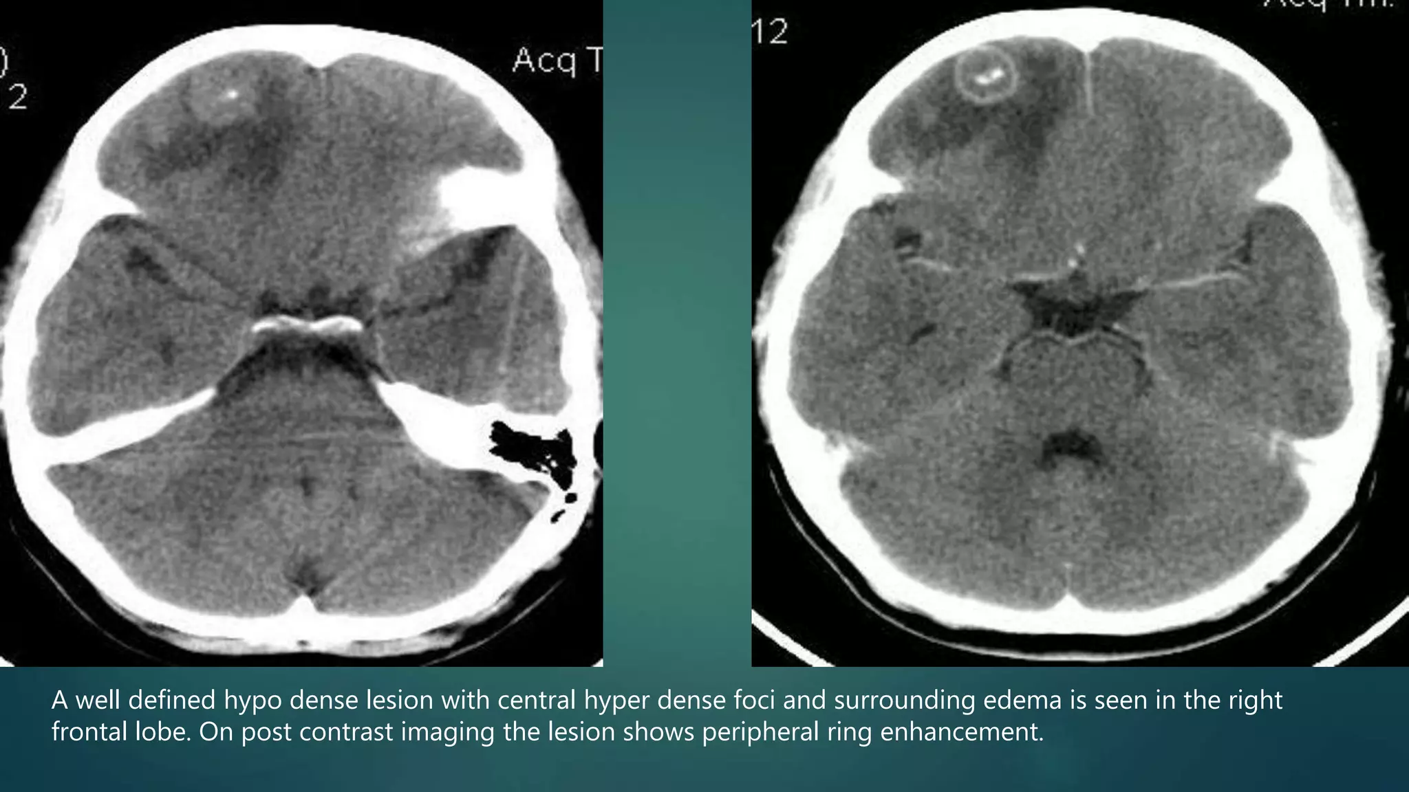 Imaging in multiple ring enhancing brain lesions | PPTX