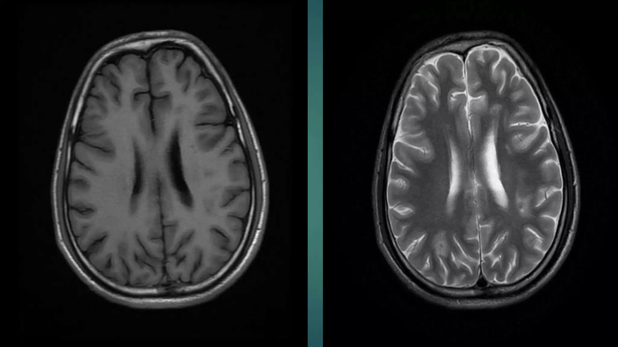 Imaging in multiple ring enhancing brain lesions | PPTX