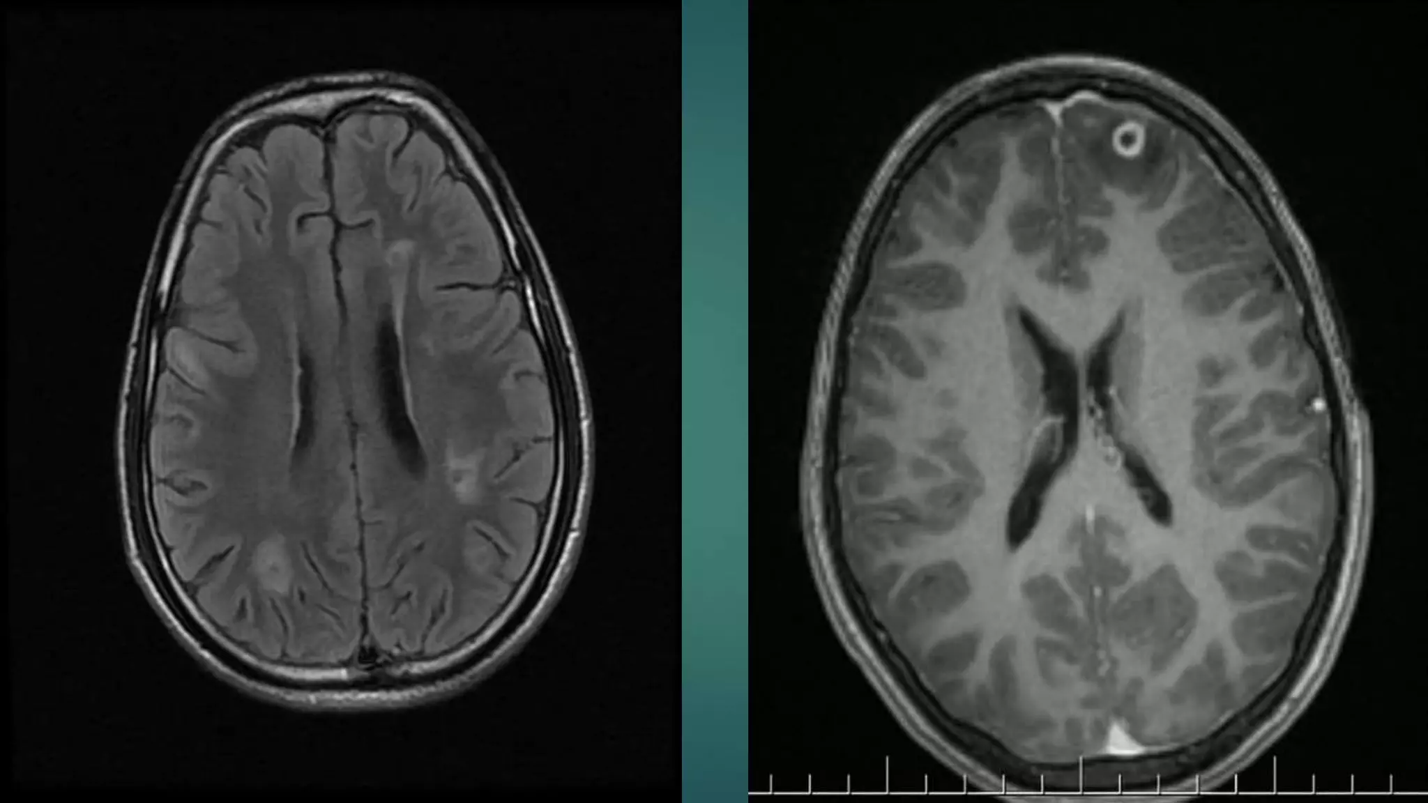 Imaging in multiple ring enhancing brain lesions | PPTX