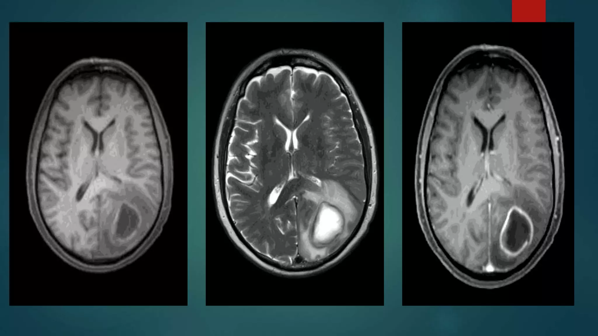 Imaging in multiple ring enhancing brain lesions | PPTX