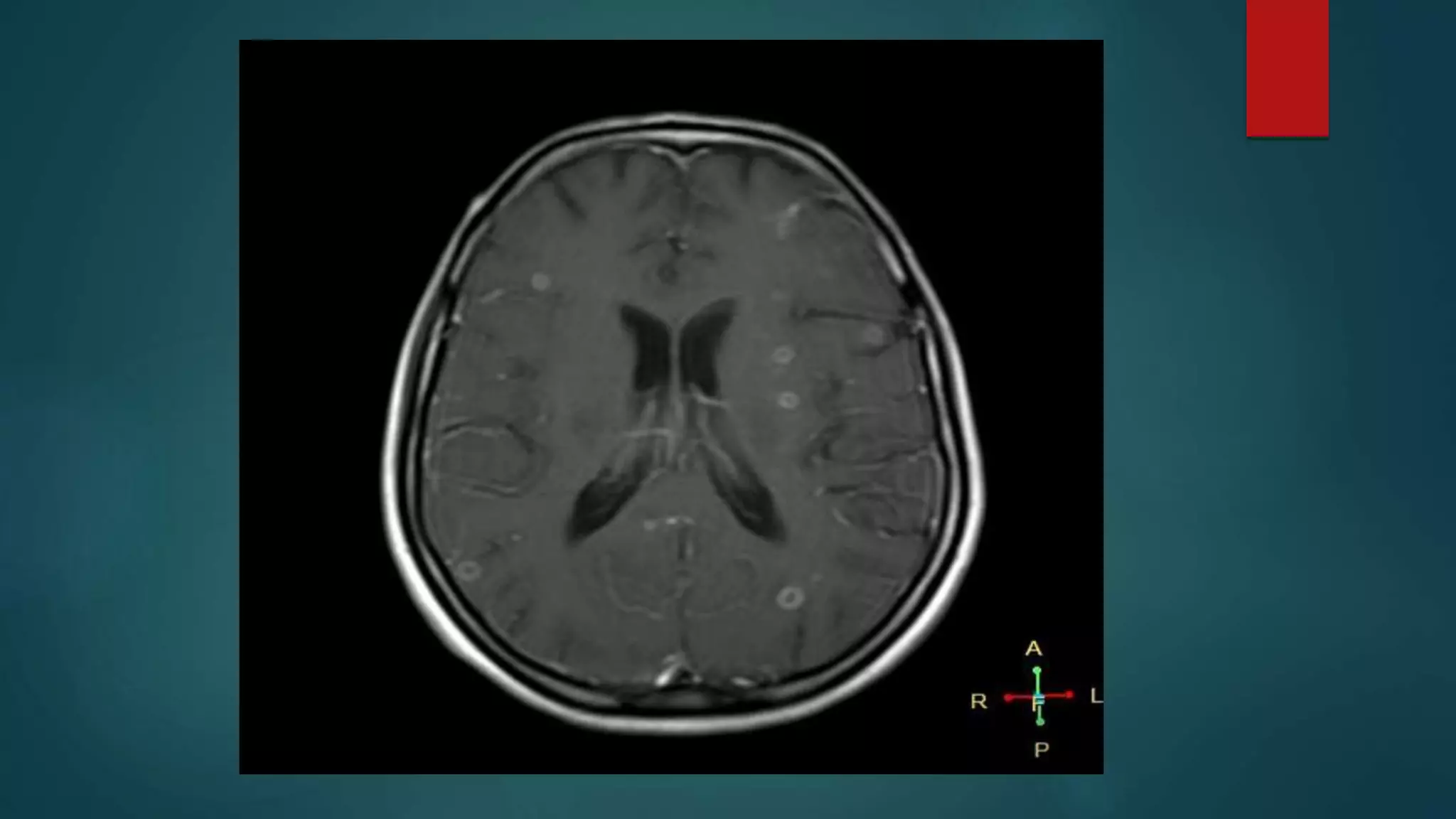 Imaging in multiple ring enhancing brain lesions | PPTX