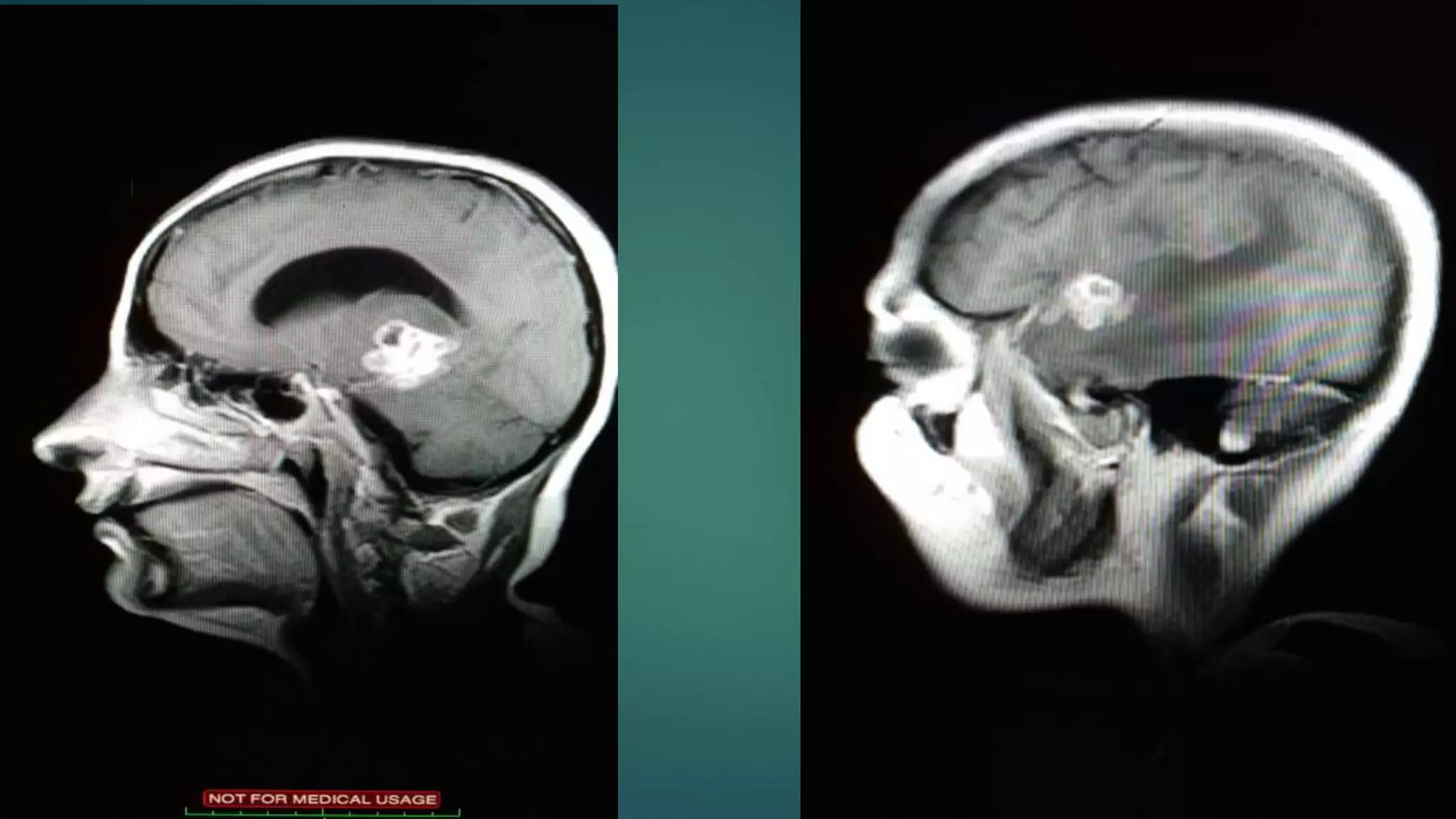 Imaging in multiple ring enhancing brain lesions | PPTX