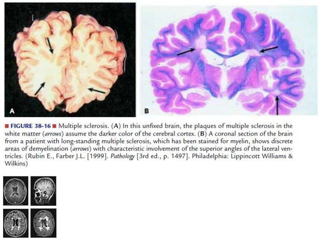 Multiple sclerosis: Medical and Nursing Managements | PPTX | Brain and ...