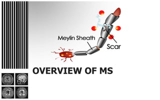 Multiple sclerosis | PPTX