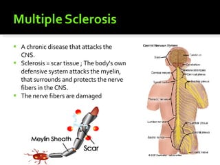 Multiple Sclerosis | PPT