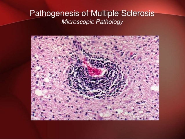 Multiple sclerosis and newer concept in management till 2014 may