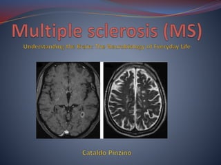 Multiple sclerosis | PPTX