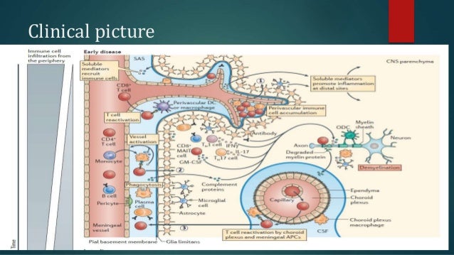Multiple Sclerosis Diagram