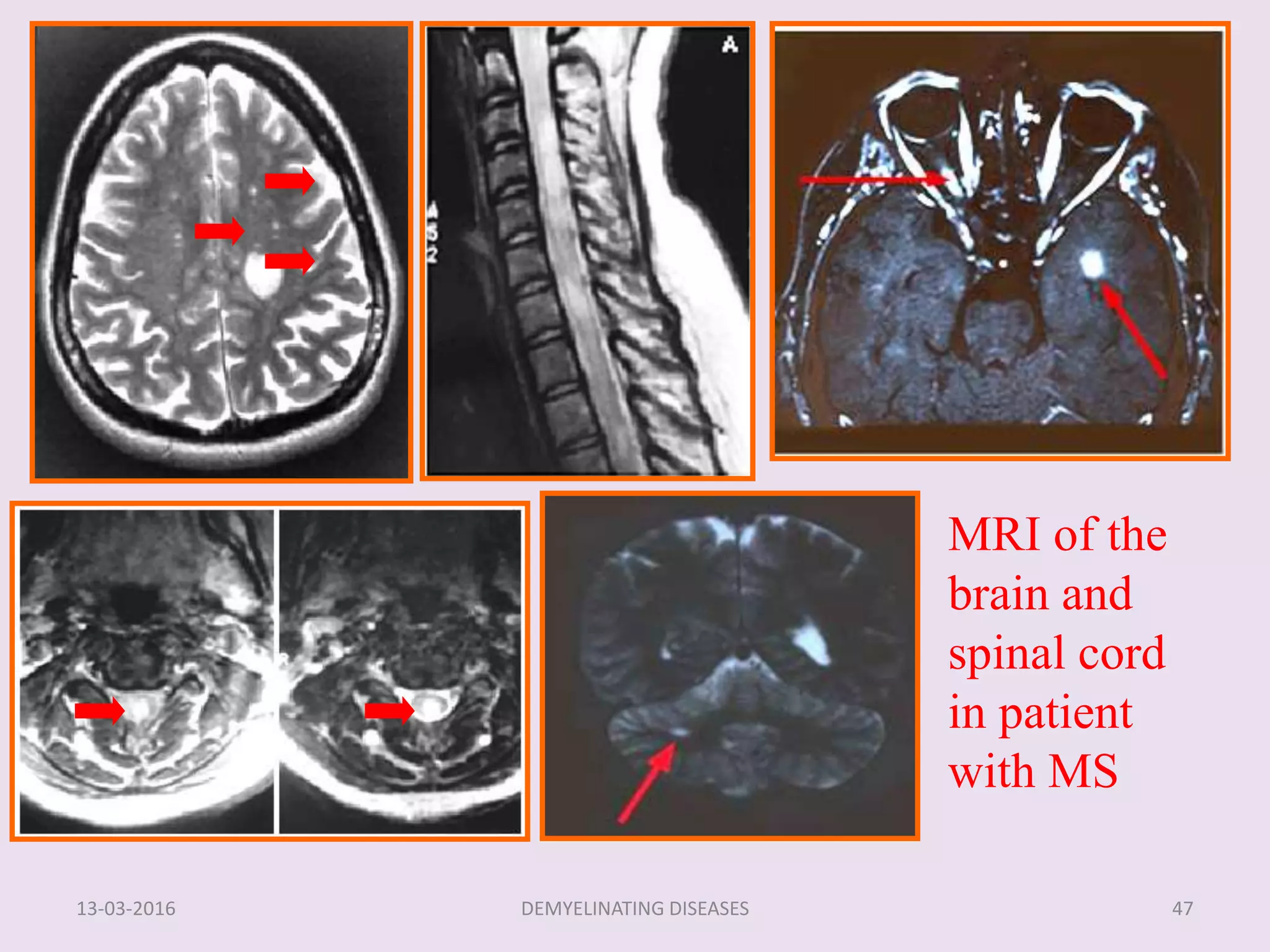 Demyelinating diseases | PPTX