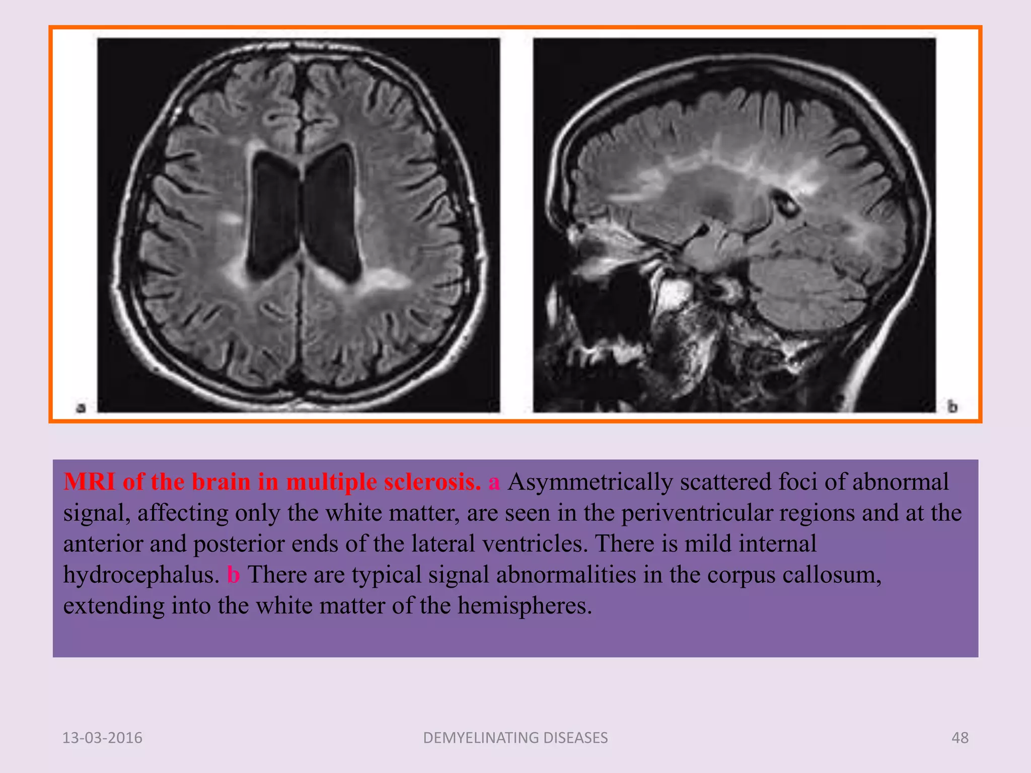 Demyelinating diseases | PPTX
