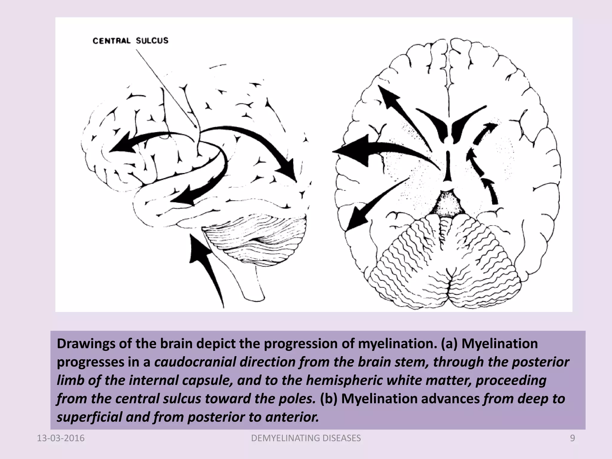 Demyelinating diseases | PPTX