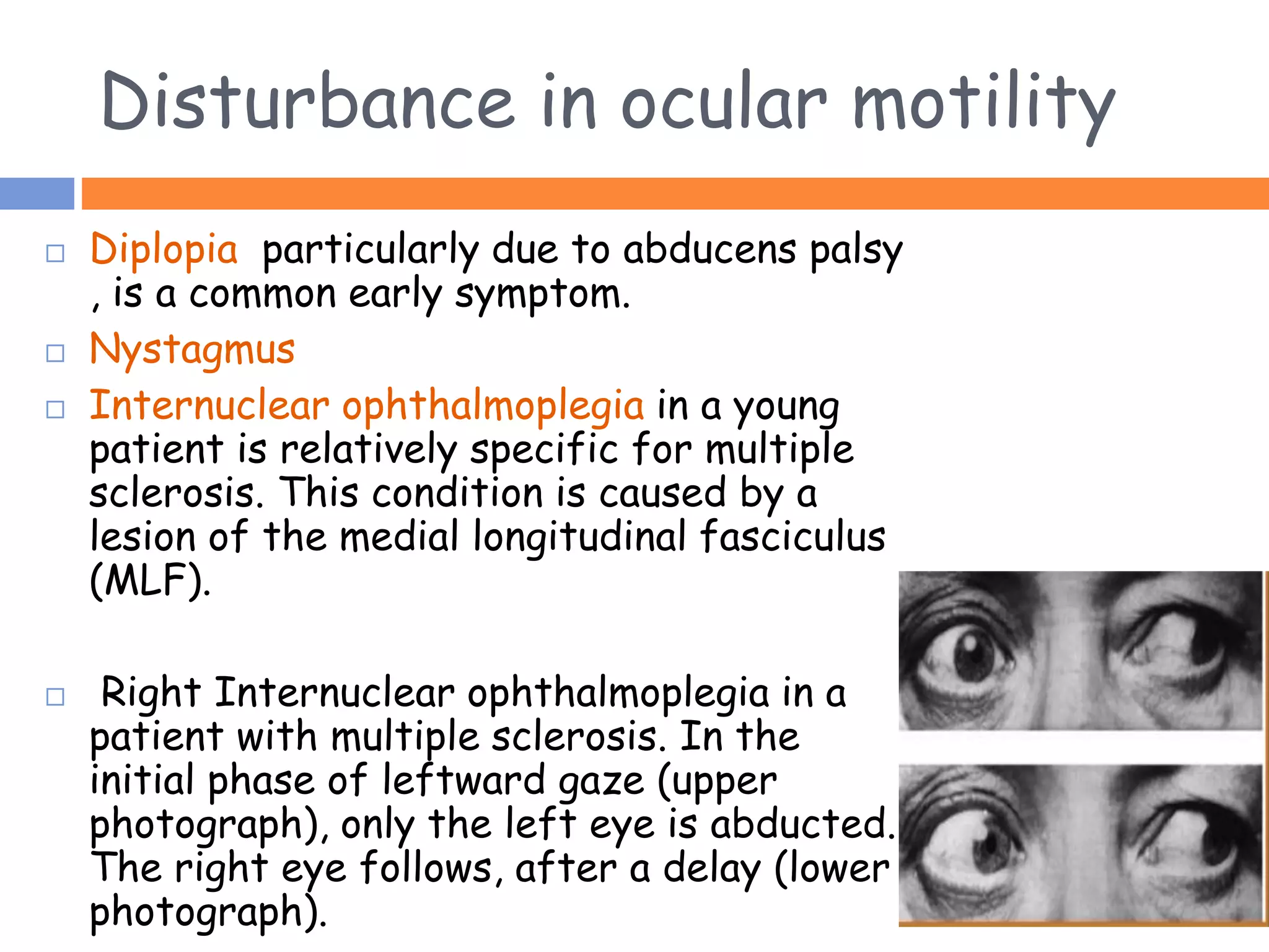 Multiple sclerosis | PPTX