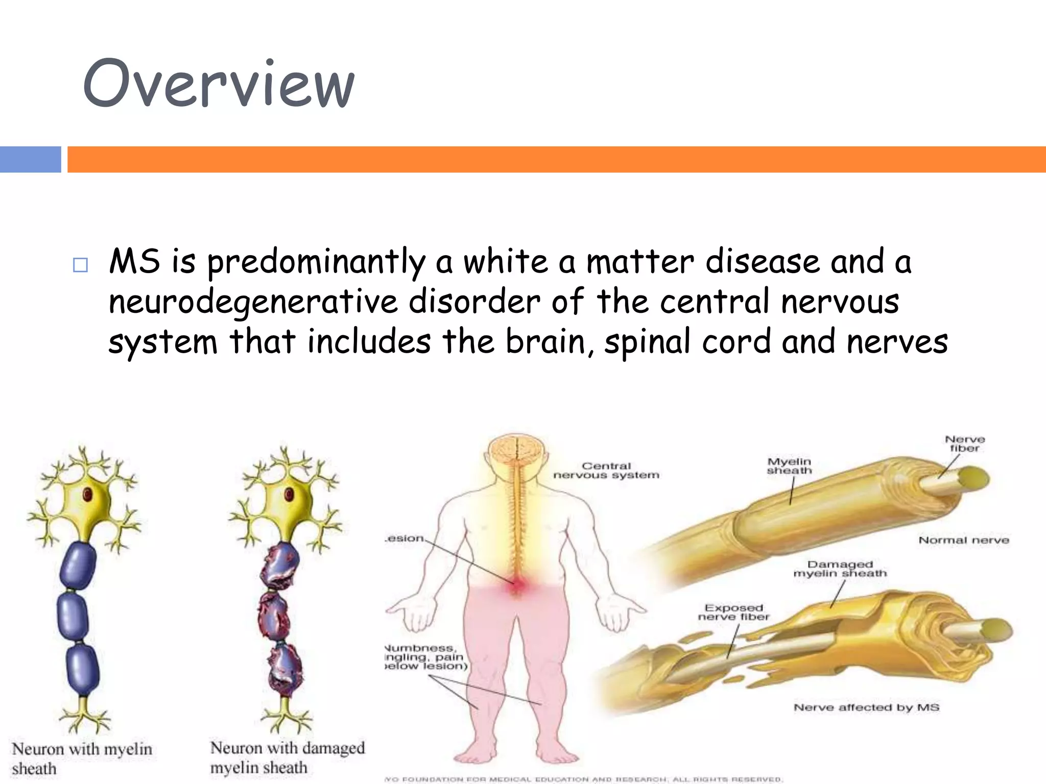 Multiple sclerosis | PPTX