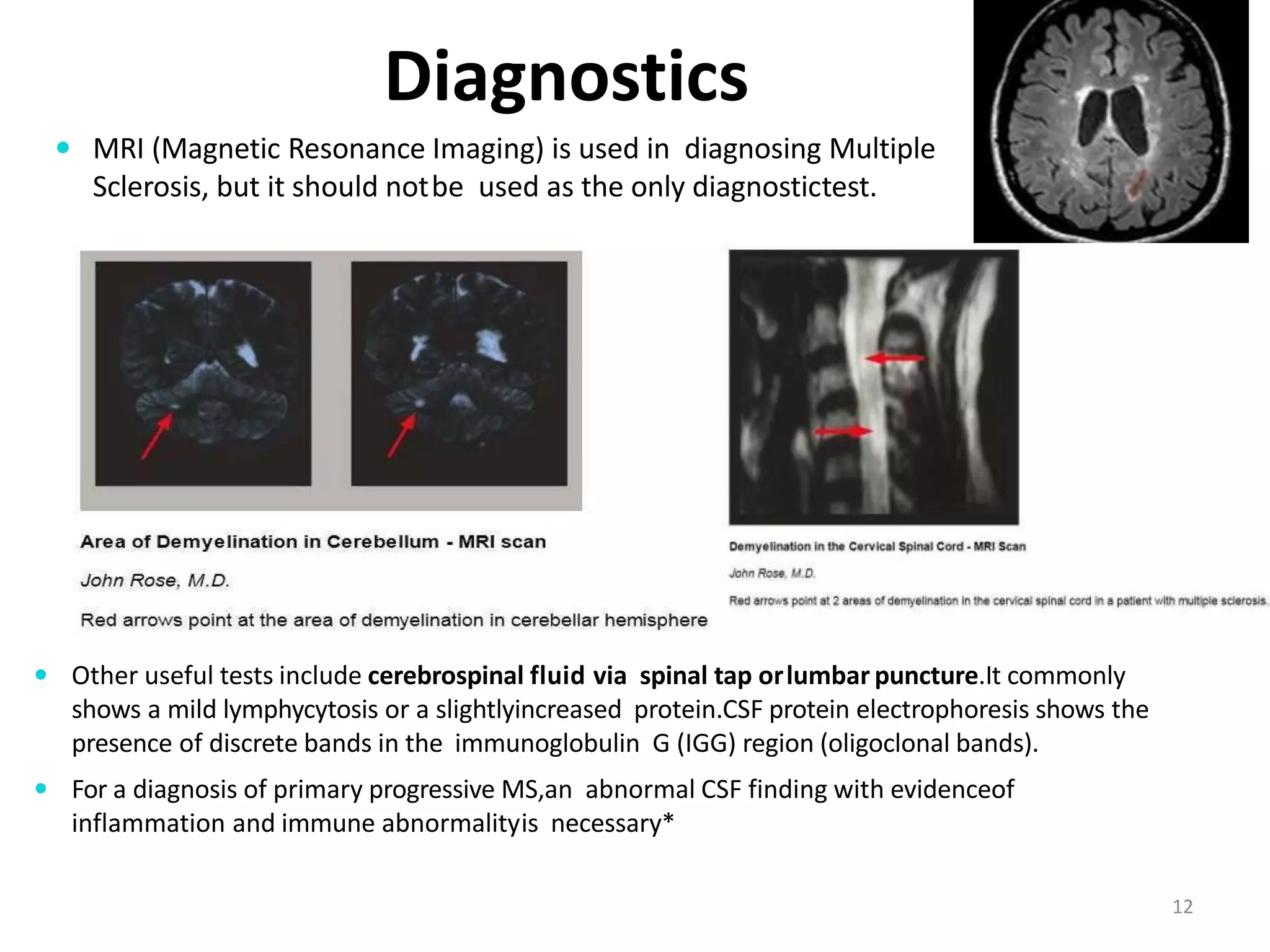 Multiple sclerosis | PPTX