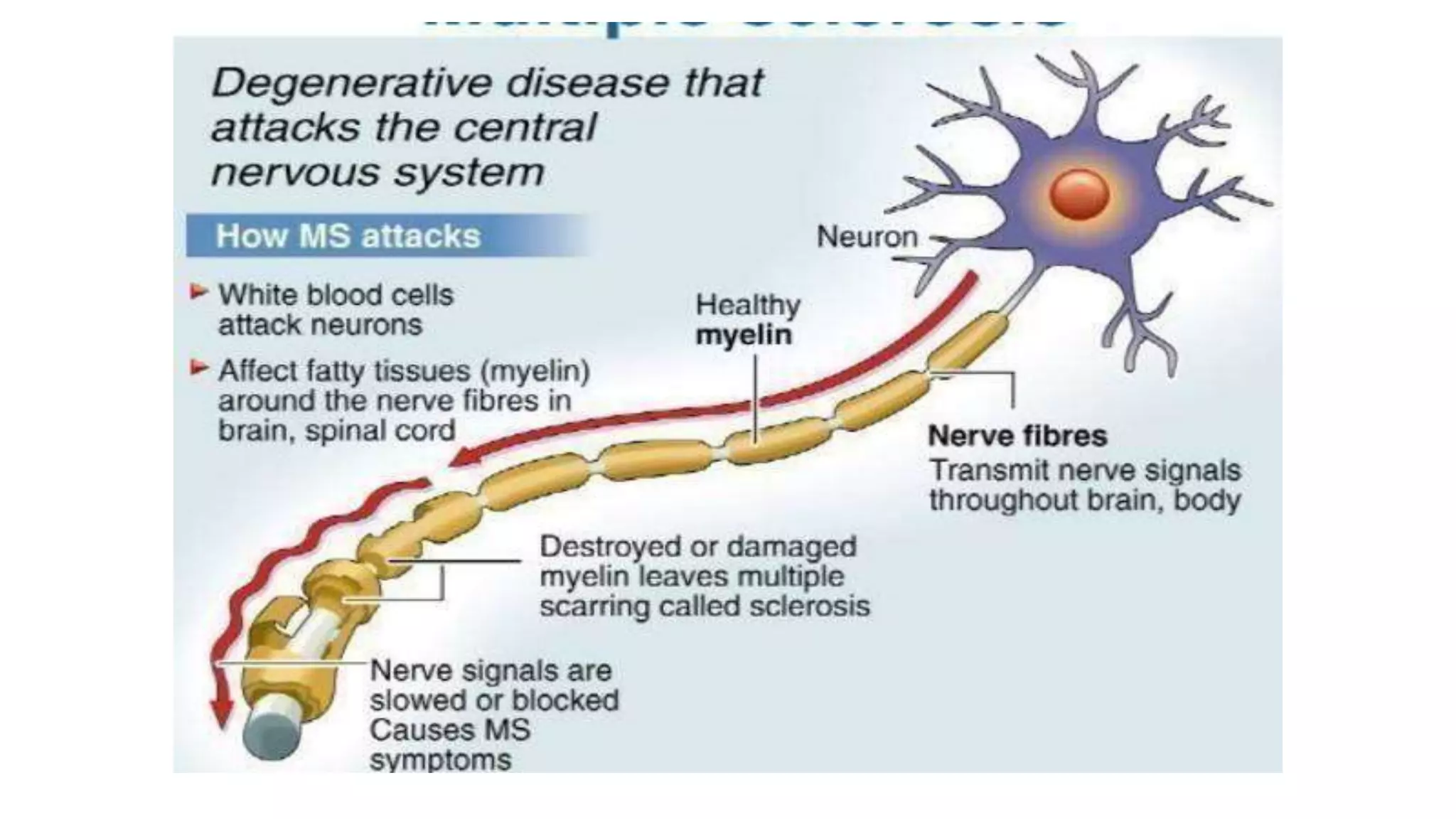 Multiple sclerosis, Types and Treatment | PPT