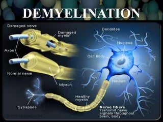 Austin Journal of Multiple Sclerosis & Neuroimmunology | PPT