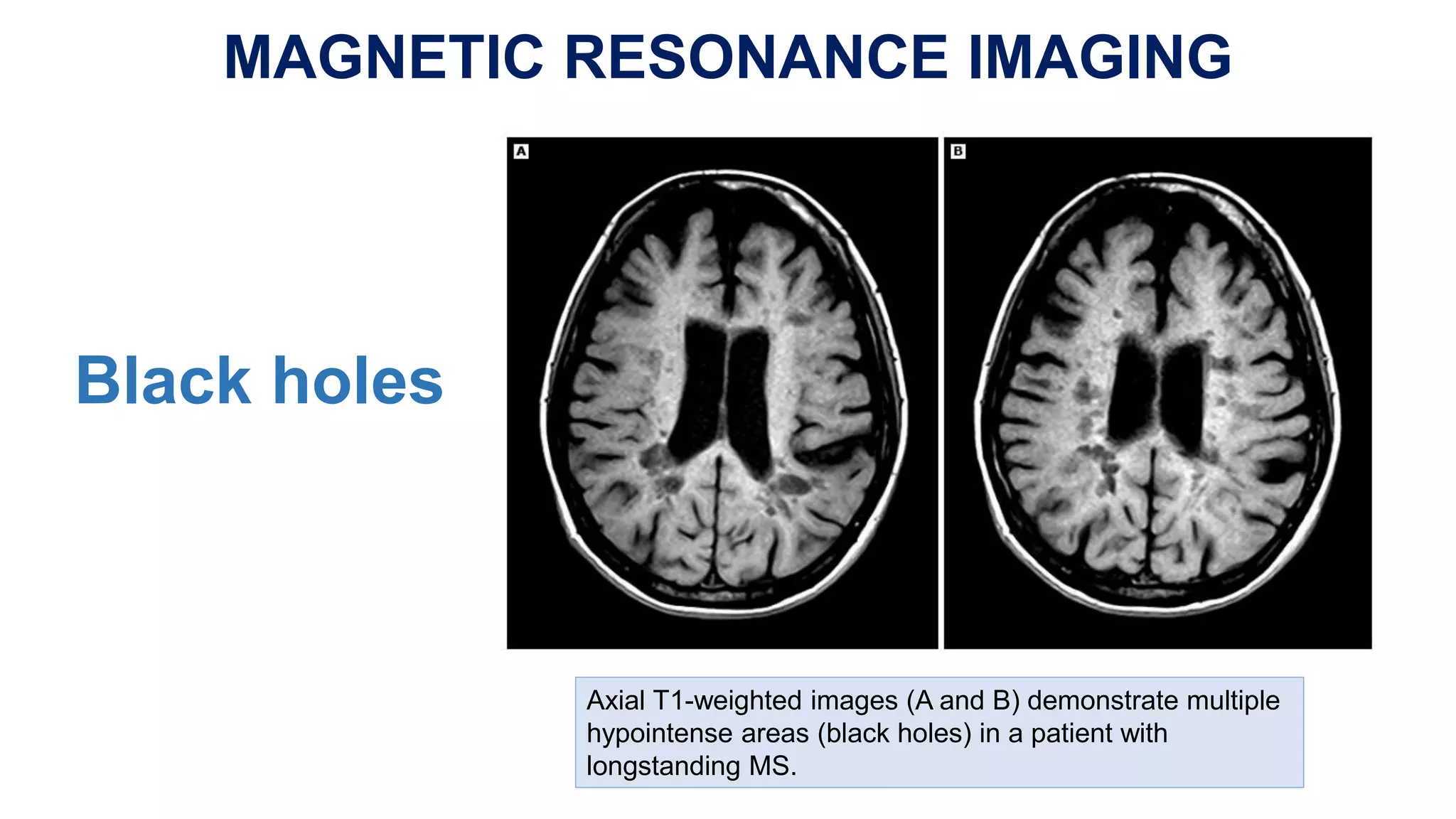 Multiple sclerosis: Introduction, Risk Factors, Diagnosis and Treatment ...