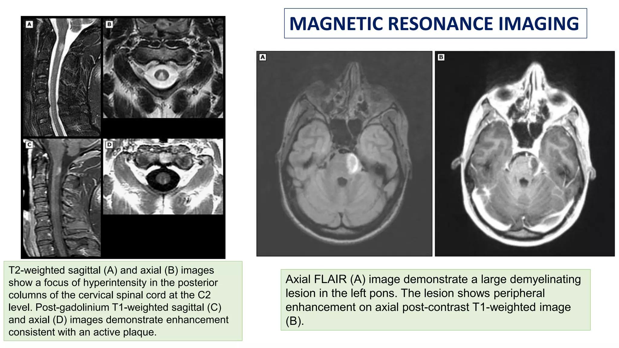Multiple sclerosis: Introduction, Risk Factors, Diagnosis and Treatment ...