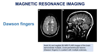 Multiple sclerosis: Introduction, Risk Factors, Diagnosis and Treatment ...