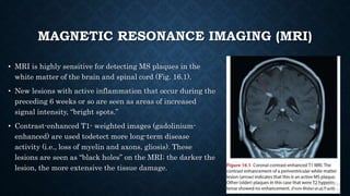 Multiple sclerosis | PPTX