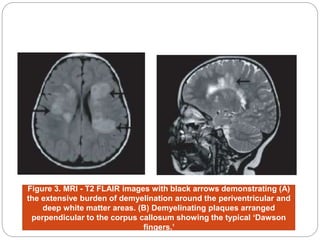 Multiple sclerosis | PPTX