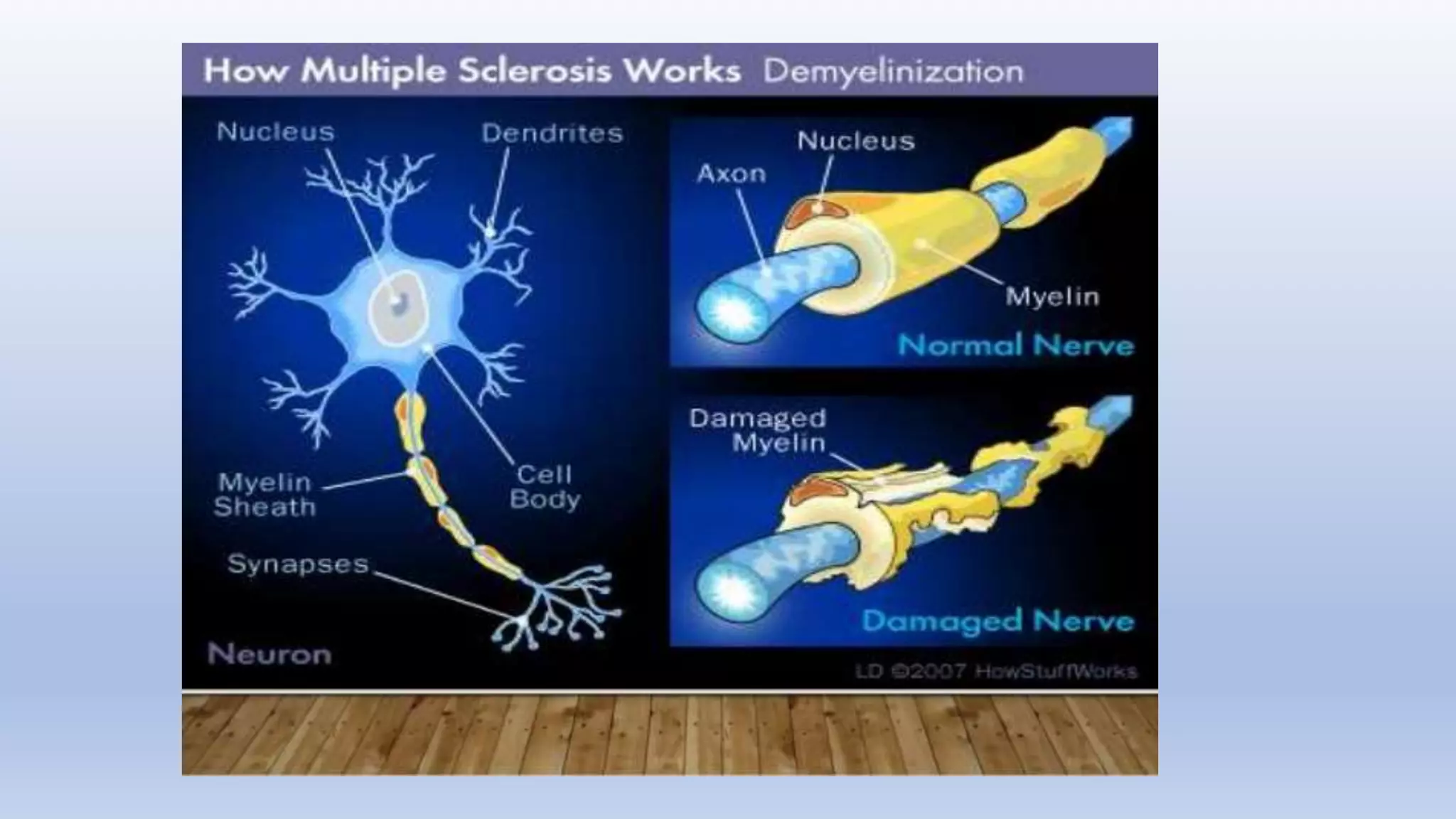 screening model for Multiple sclerosis | PPTX