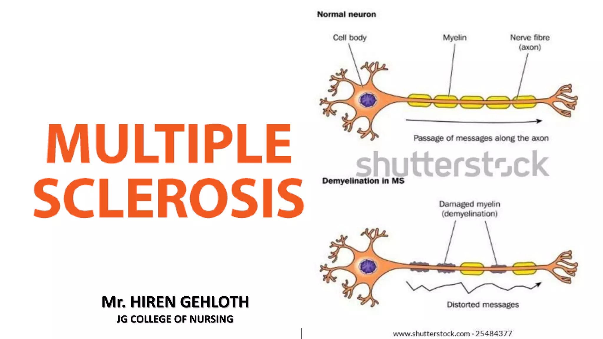 Multiple sclerosis | PPTX
