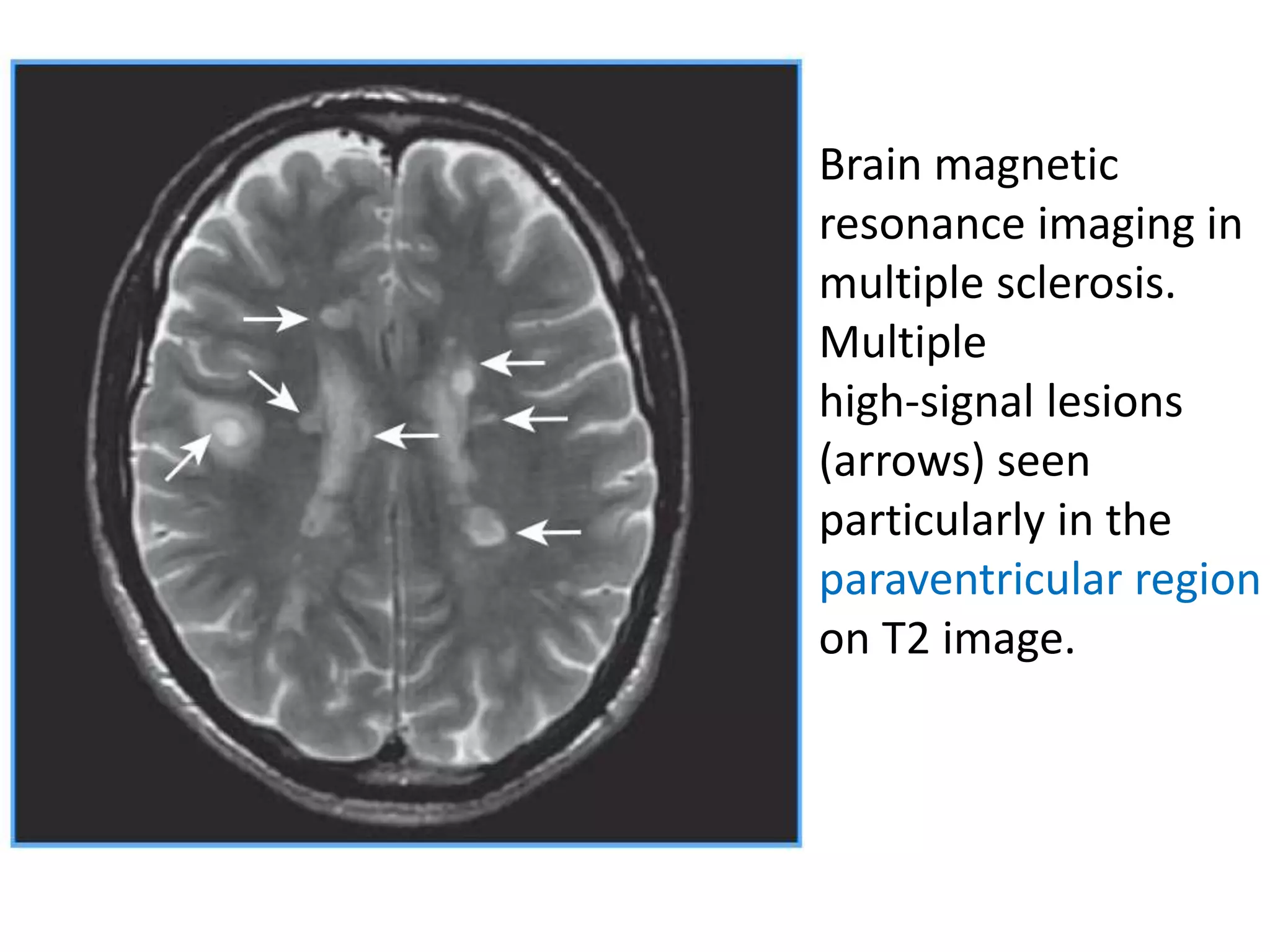 Multiple sclerosis.ppt