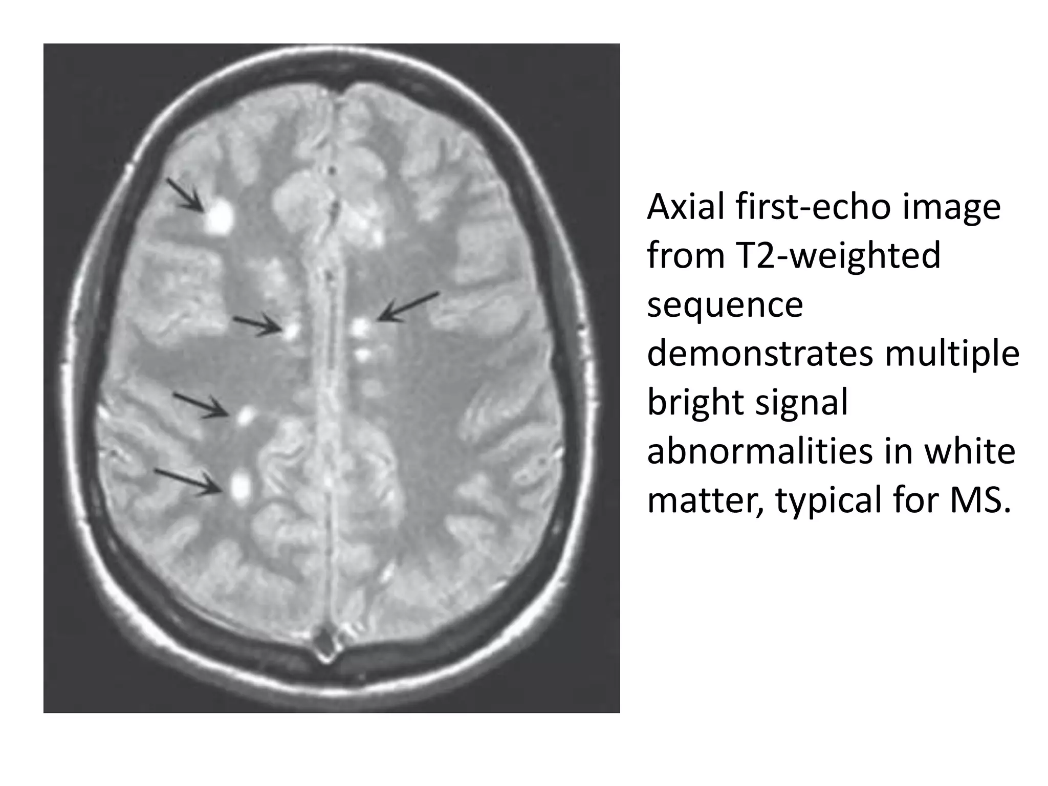 Multiple sclerosis.ppt