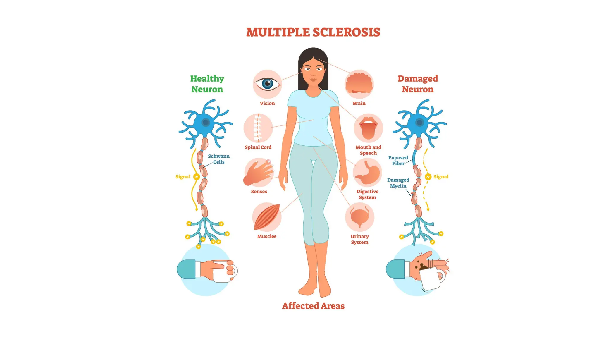 multiple sclerosis.pdfbfhksdbgklhzgbhkgbzdskgs | PDF