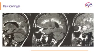demyelinated disorder: multiple sclerosis.pptx