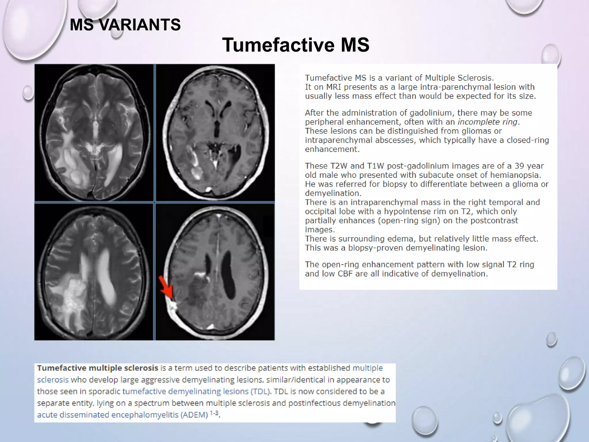 Imaging in Multiple sclerosis | PPTX