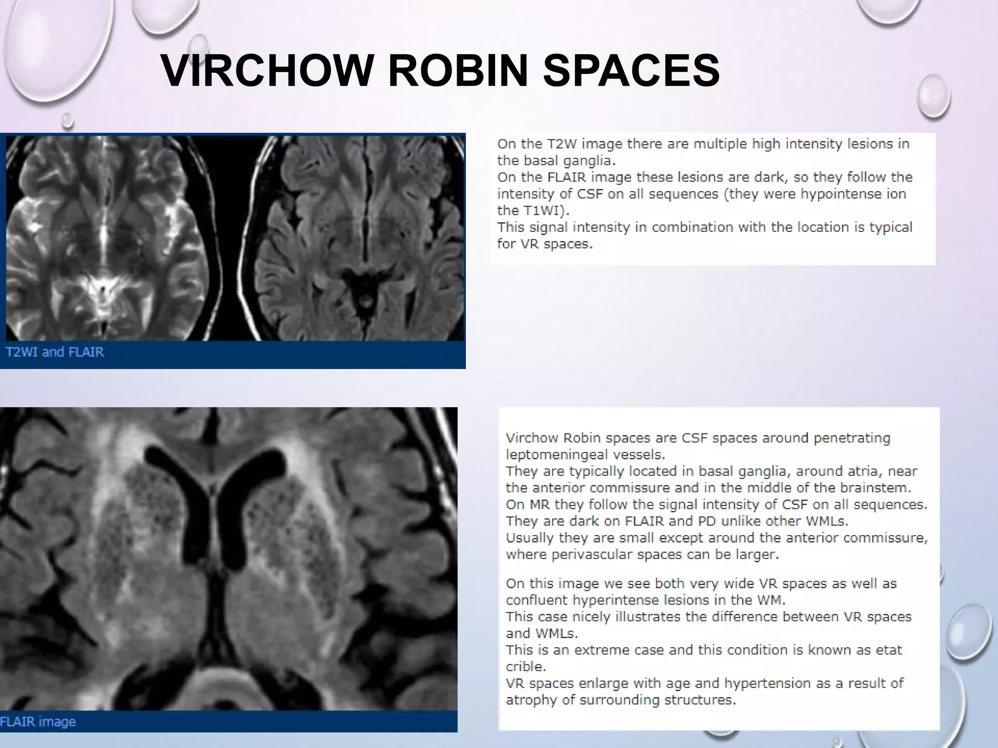 Imaging in Multiple sclerosis | PPTX