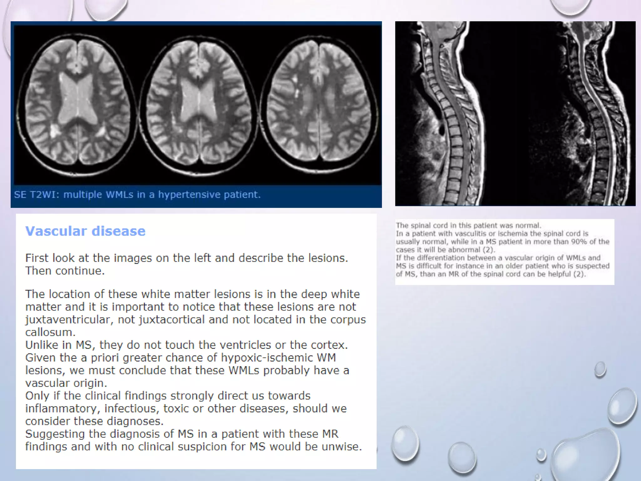 Imaging in Multiple sclerosis | PPTX