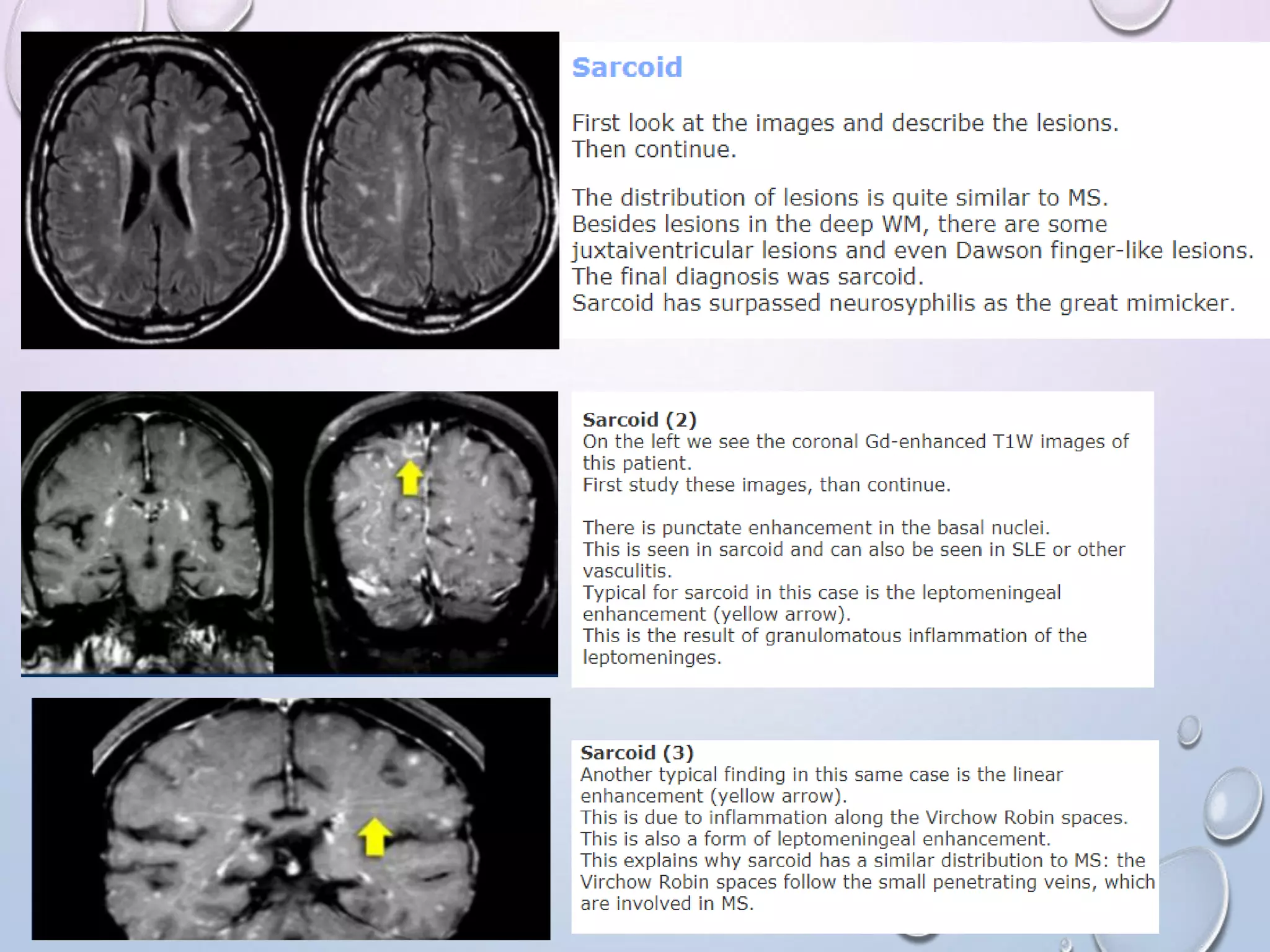 Imaging in Multiple sclerosis | PPTX
