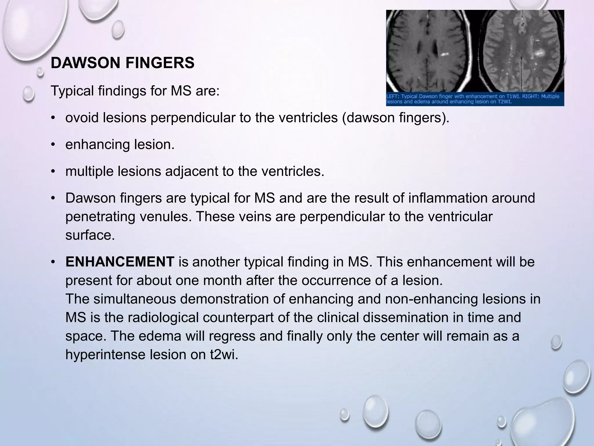 Imaging in Multiple sclerosis | PPTX