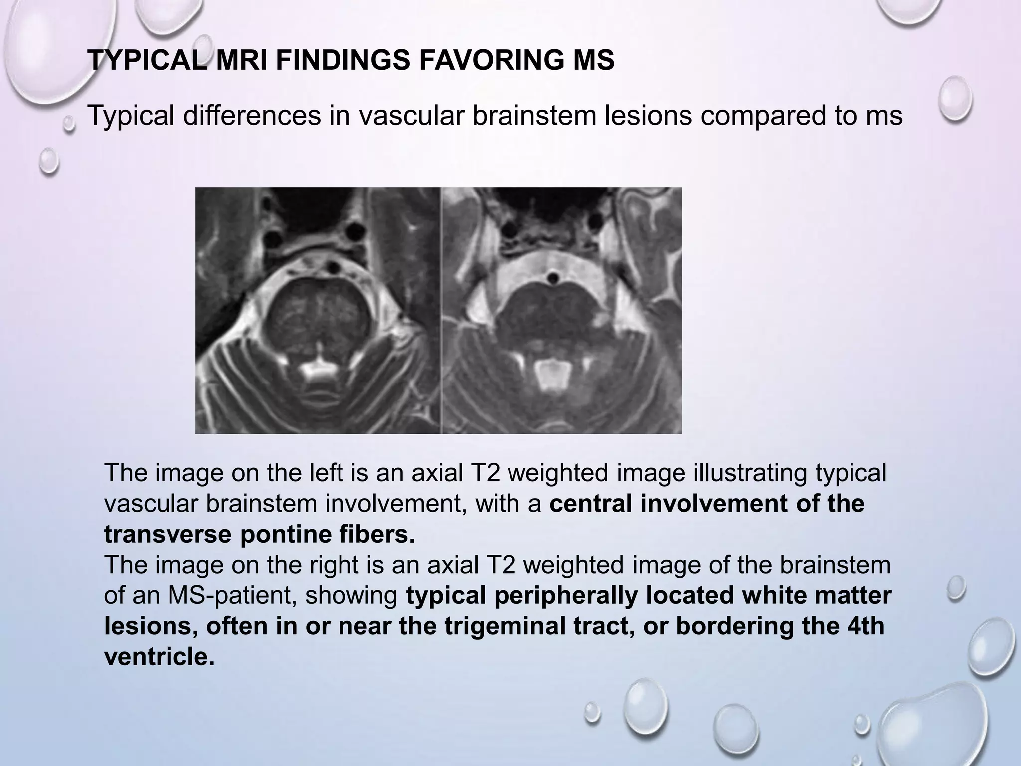 Imaging in Multiple sclerosis | PPTX