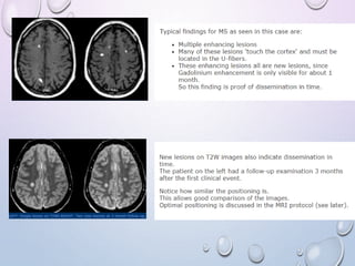 Imaging in Multiple sclerosis | PPTX