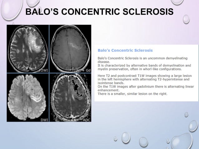 Imaging in Multiple sclerosis | PPTX