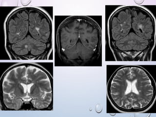 Imaging in Multiple sclerosis | PPTX
