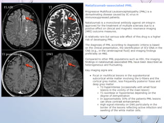 Imaging in Multiple sclerosis | PPTX