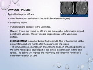 Imaging in Multiple sclerosis | PPTX