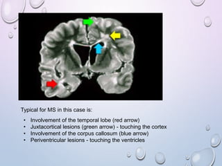 Imaging in Multiple sclerosis | PPTX