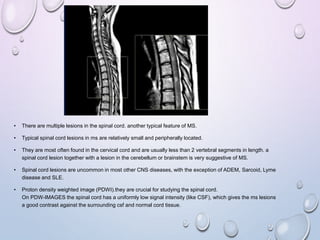 Imaging in Multiple sclerosis | PPTX