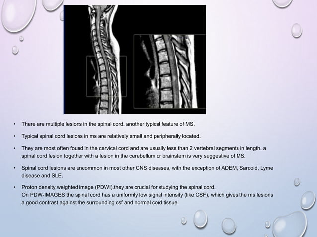 Imaging in Multiple sclerosis | PPTX