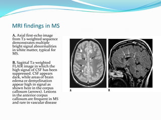 Multiple sclerosis (neurology) dr sikander ali | PPTX